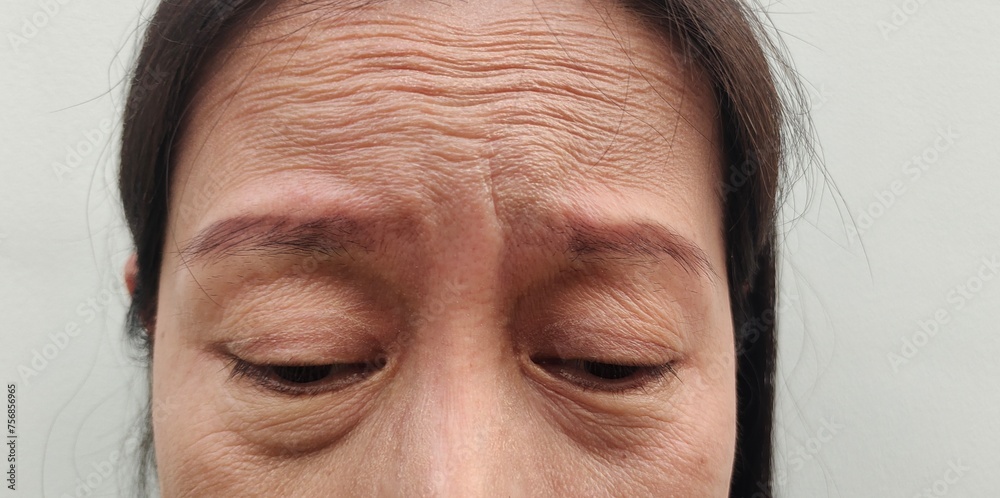portrait showing the forehead lines and wrinkles, dark spots and ...