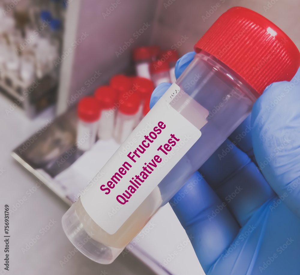 Semen sample for semen fructose test. Human fertility diagnosis sperms ...