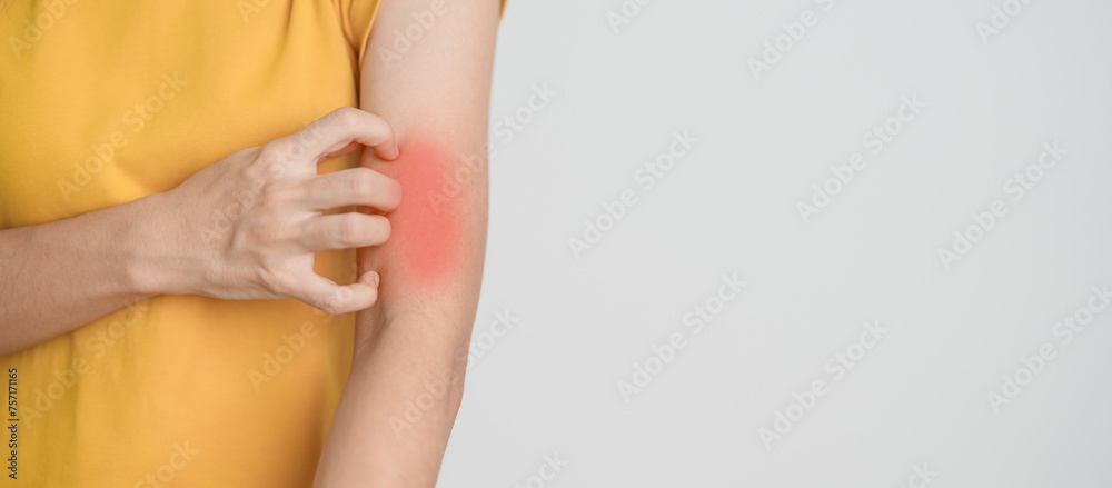 woman itching and scratching itchy arm. Sensitive Skin Allergic ...