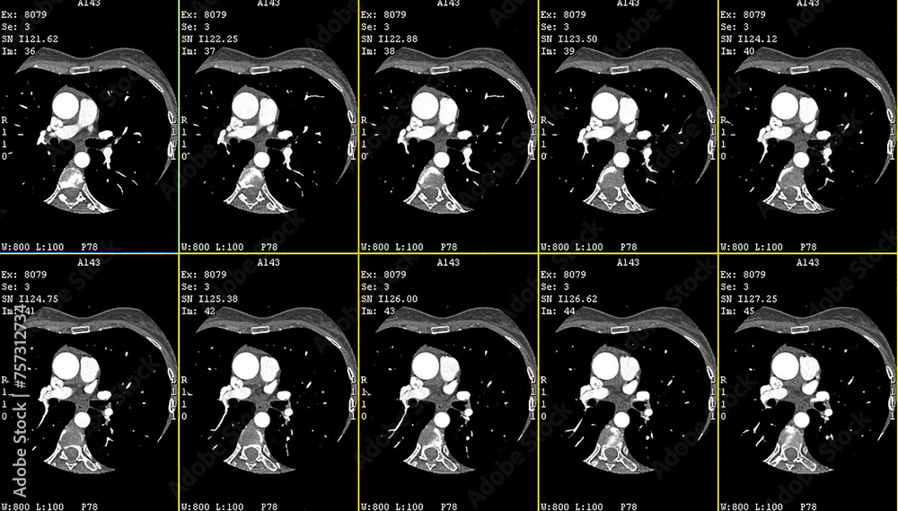 A computerized tomography CT coronary angiogram. Axial contrast of the cardio system with ...