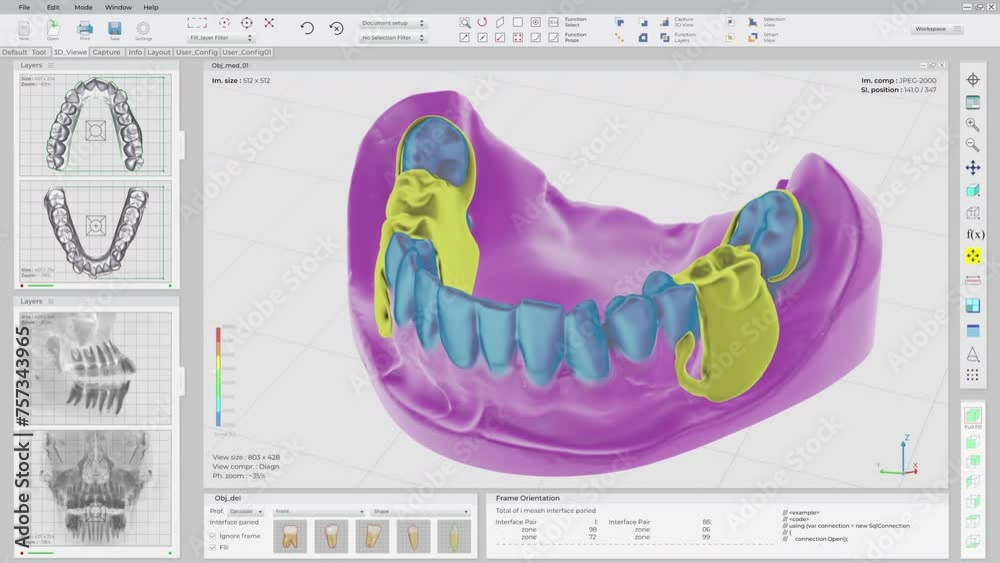 Fixing Missing Teeth With Prosthetic Dental Bridge In Software For ...