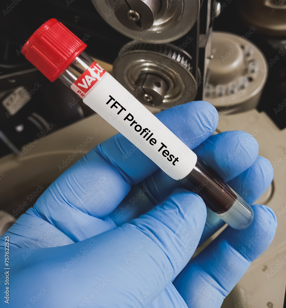 Blood sample for TFT (thyroid function test), to diagnosis of ...