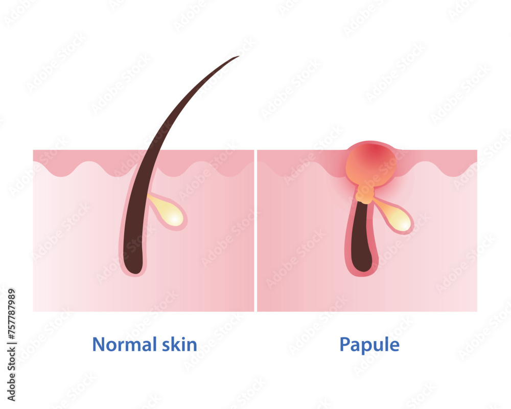 Papule, type of inflammatory acne vector isolated on white background ...