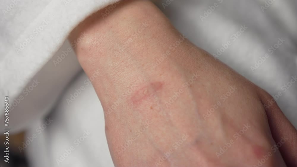 Women in white coat is showing burn mark on hand. Dermatitis, eczema ...