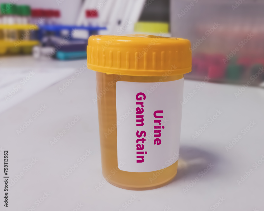 Urine sample for Gram staining, to identify gram positive and gram ...