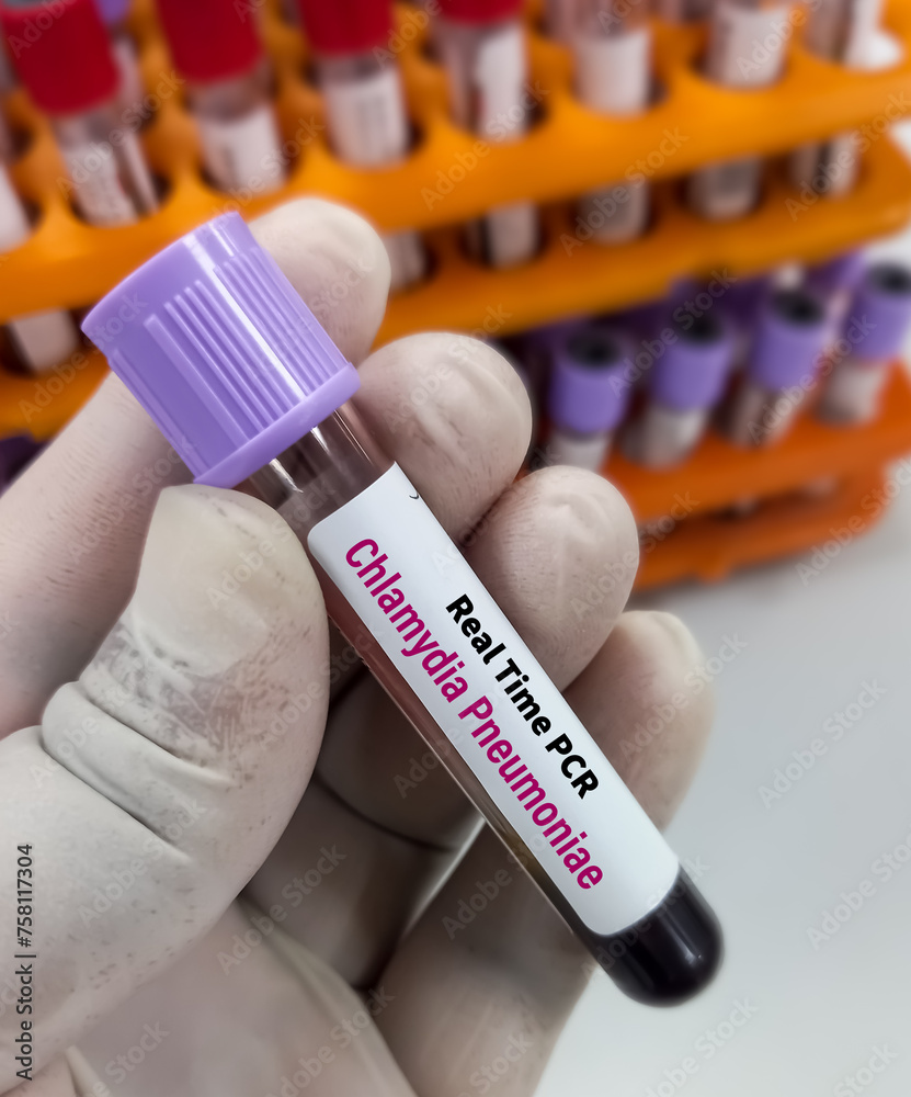 Blood sample for Chlamydia pneumoniae PCR test. testing for acute ...