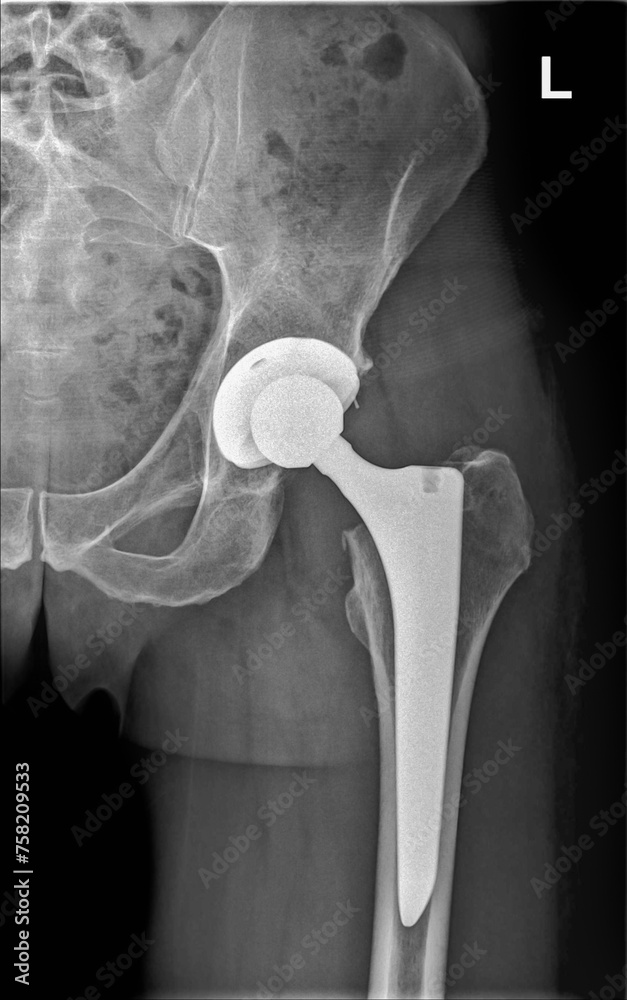 X-ray photo of left hip prosthesis of man. Total hip replacement. 6 ...