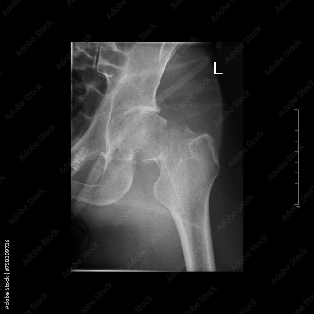 Left transcervical neck fracture. Femoral neck fracture. Joint closeup ...