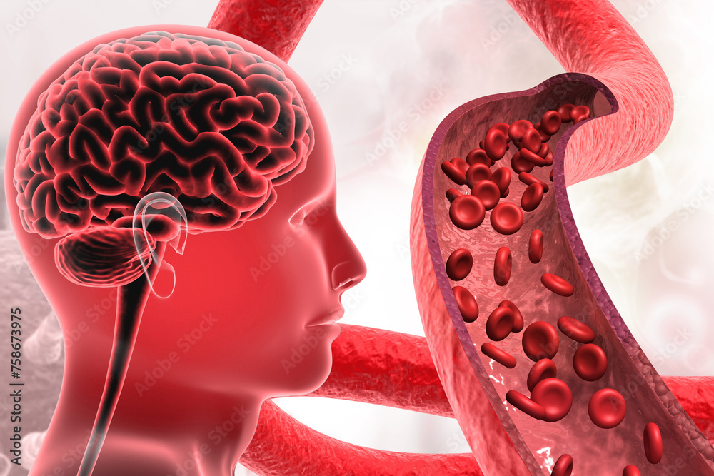 Human brain stroke concept. Clogged vein in brain. 3d illustration ...