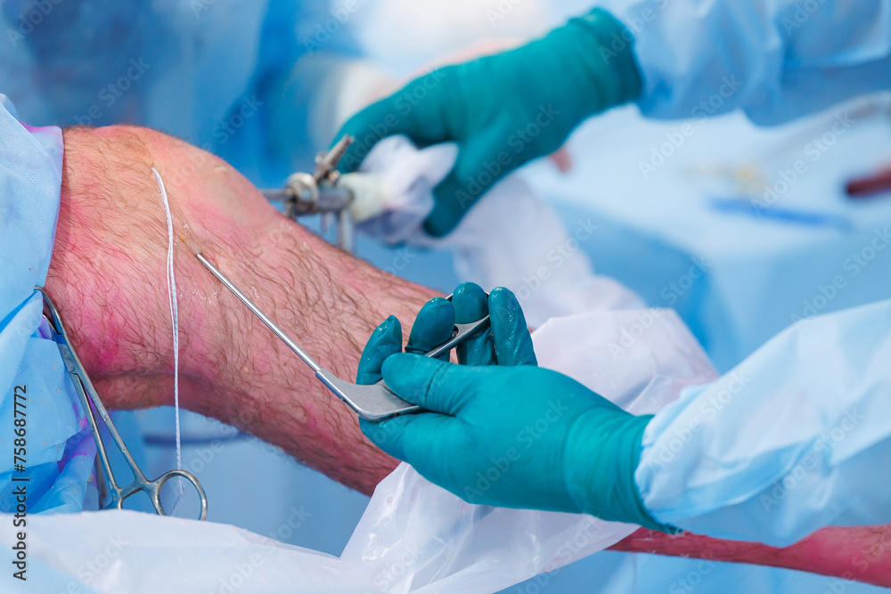 Surgeon use laparoscopic instrument for leg patient minimally invasive ...