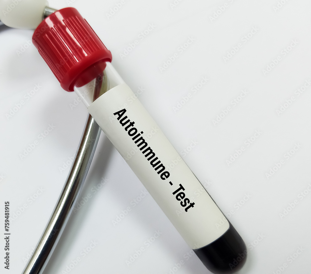 Blood sample for ANA (antinuclear antibody) test, autoimmune disease ...