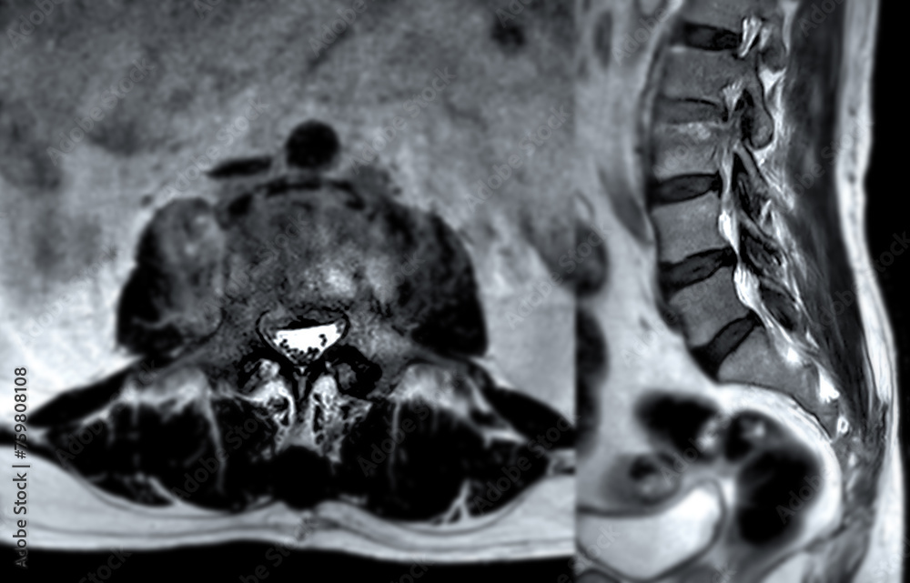 MRI L-S spine or lumbar spine Axial and sagittal T2 technique with ...