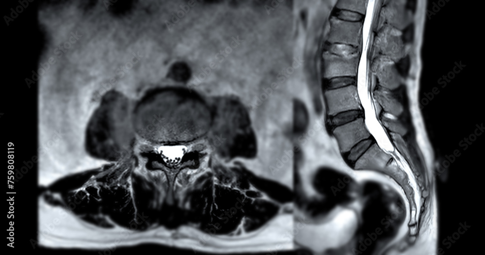 Poster MRI L-S spine or lumbar spine Axial and sagittal T2 technique ...