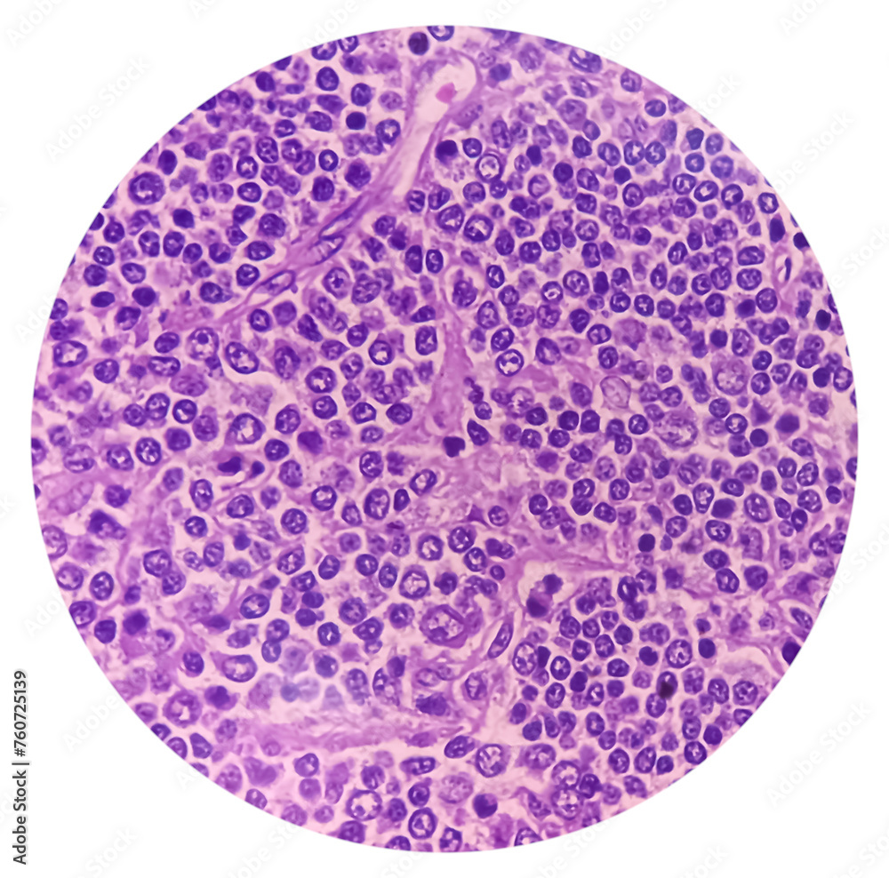 Cervical lymph node(biopsy): Non-Hodgkin's lymphoma-high grade. Light ...