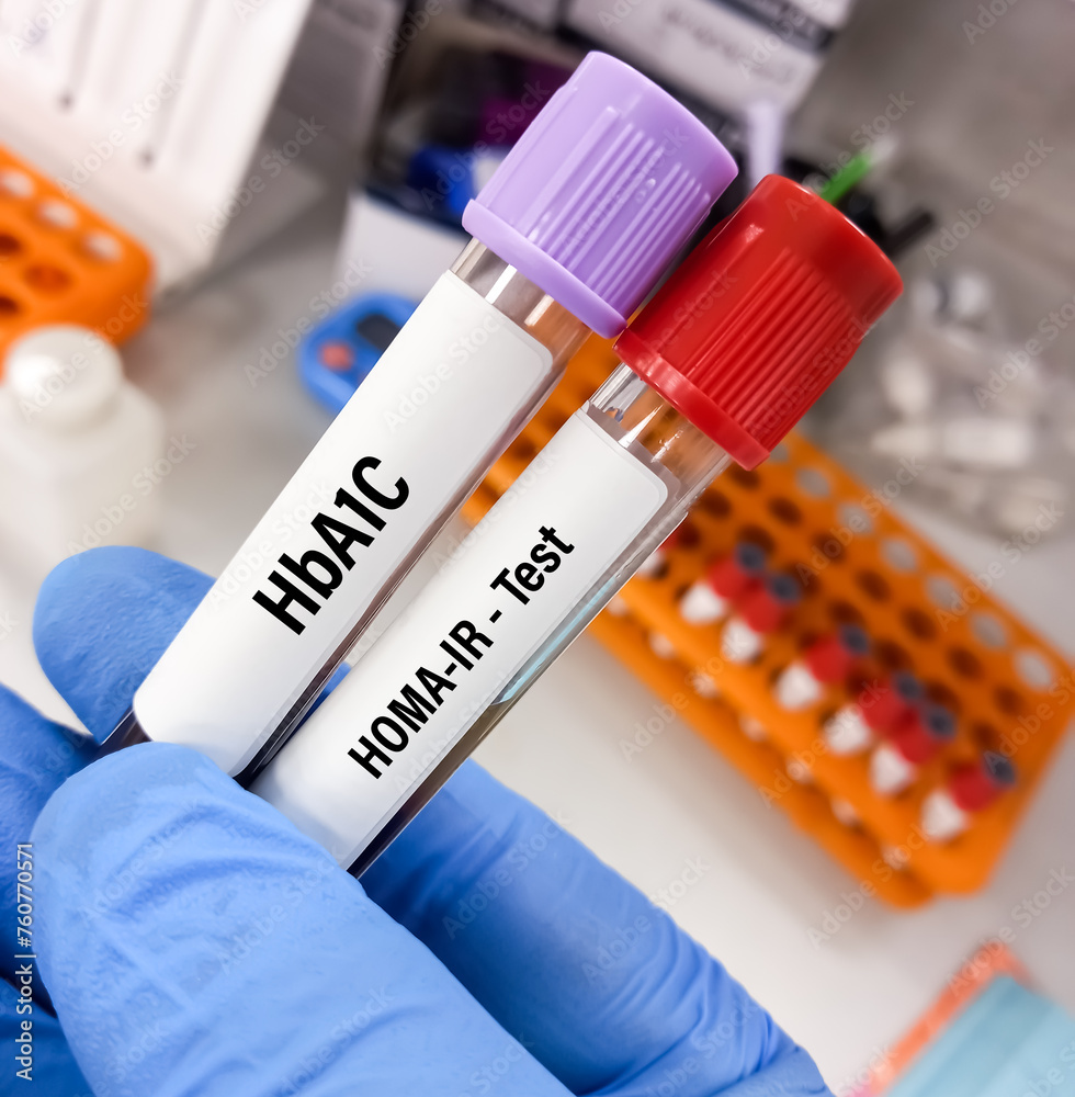 Blood sample for HOMA IR (Insulin resistance) and Hemoglobin A1C (HbA1C ...