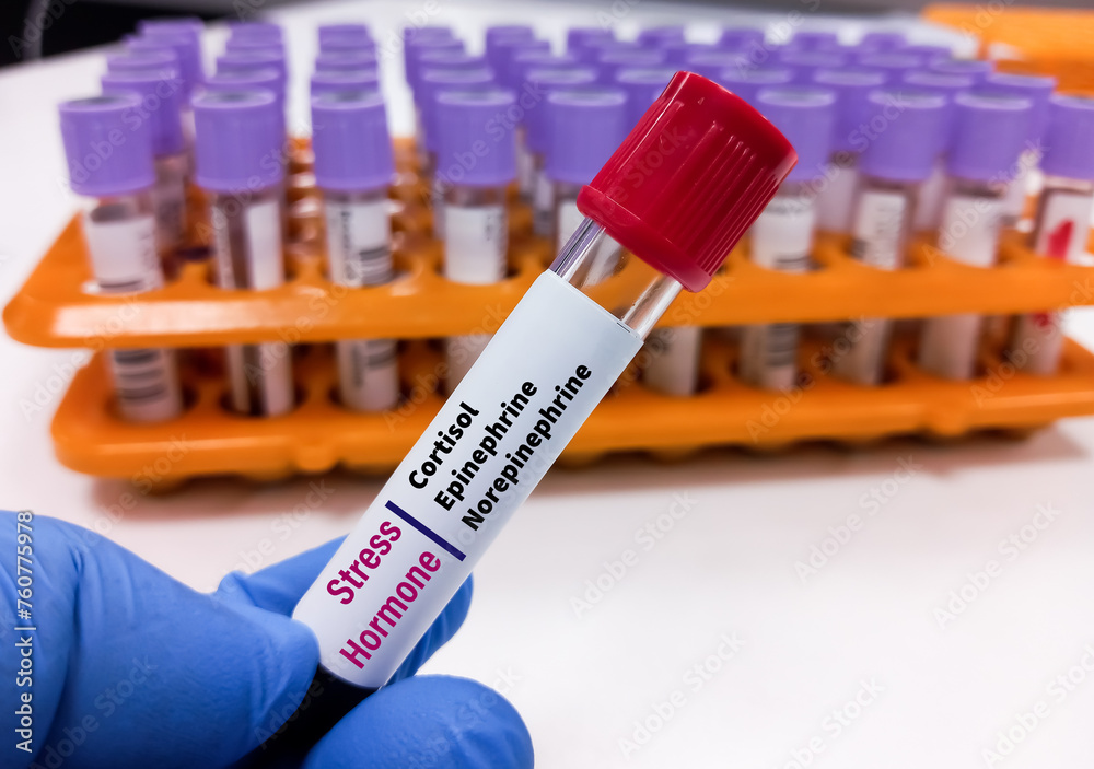Blood sample for Stress hormone test. Cortisol, epinephrine (adrenaline ...