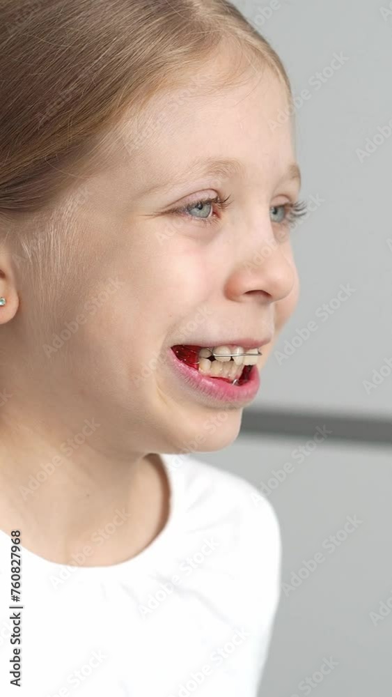 Vertical video. A child's smile with a plate for straightening teeth ...