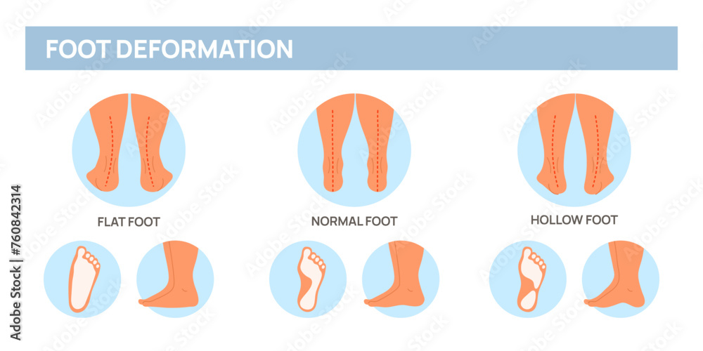 Foot deformation poster. Medical scheme with leg curvature types. Flat ...