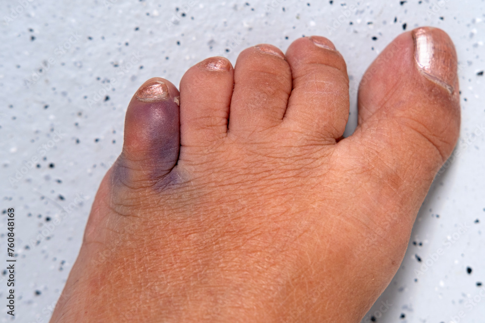 close-up part of female foot, subcutaneous hemorrhage on little toe ...