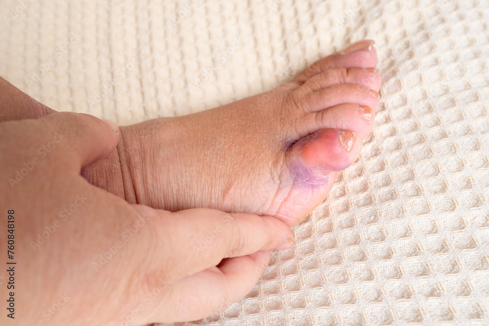 close-up part of female foot, subcutaneous hemorrhage on little toe ...