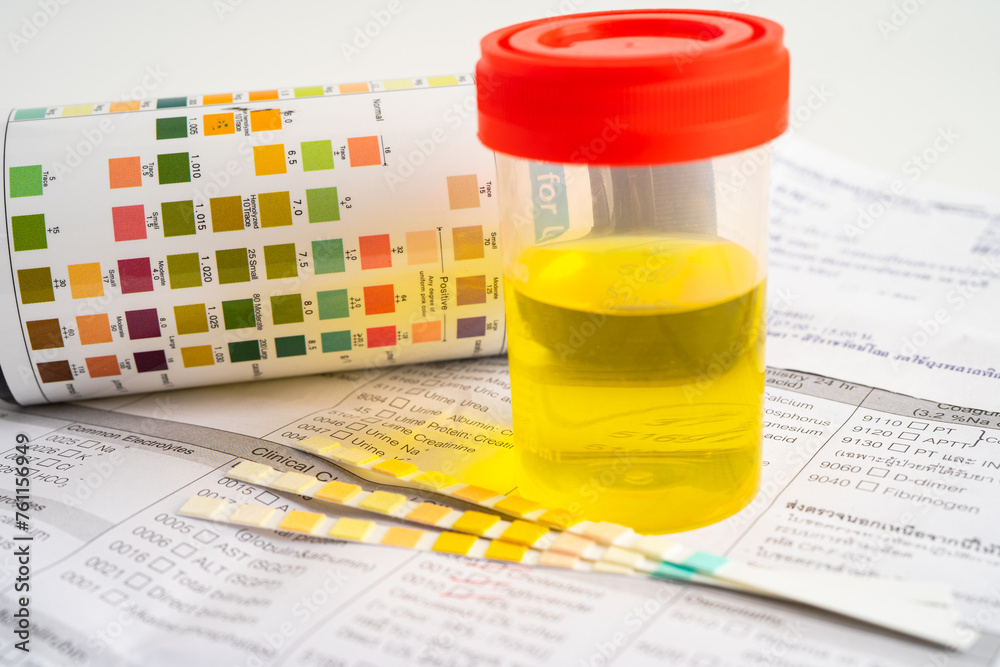 Photo & Art Print Urinalysis, urine cup with reagent strip pH paper ...