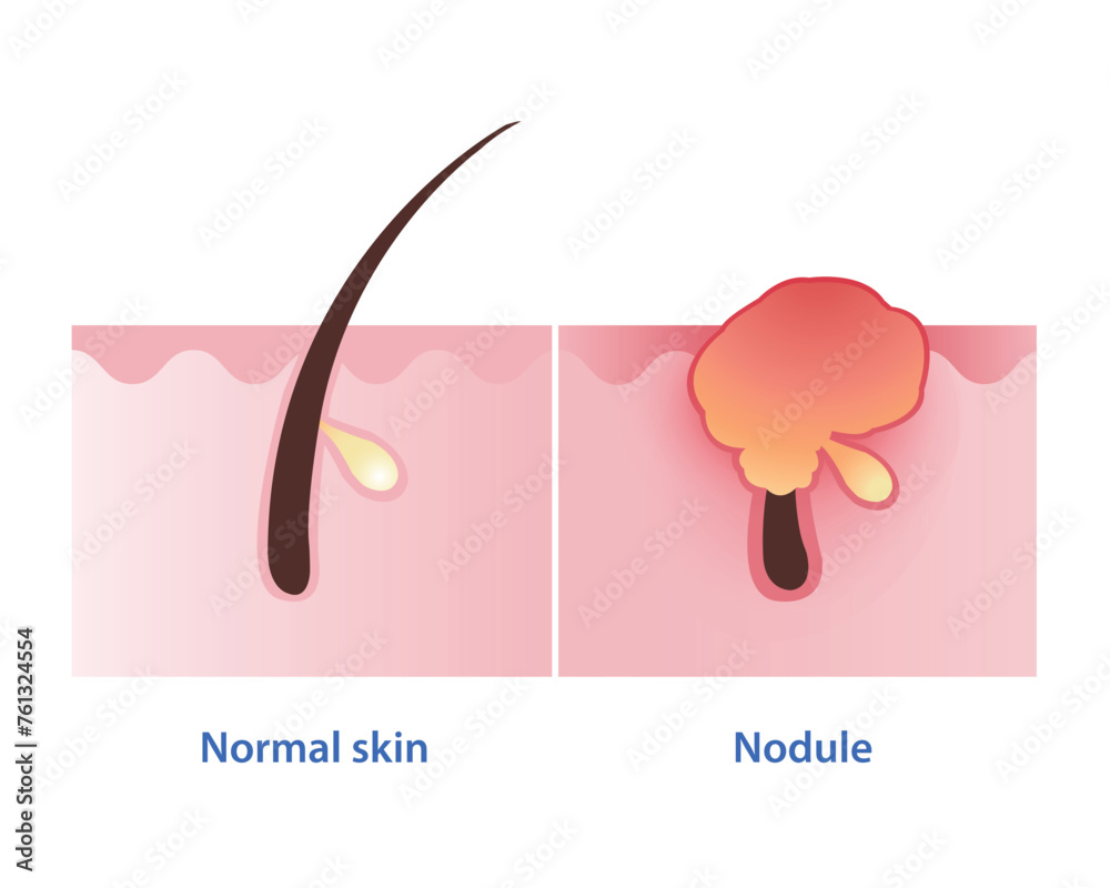 Nodule, type of inflammatory acne vector on white background. Normal ...