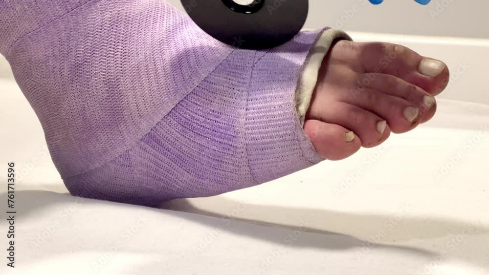 Close-up of a foot wrapped in a purple bandage, with toes exposed. The ...