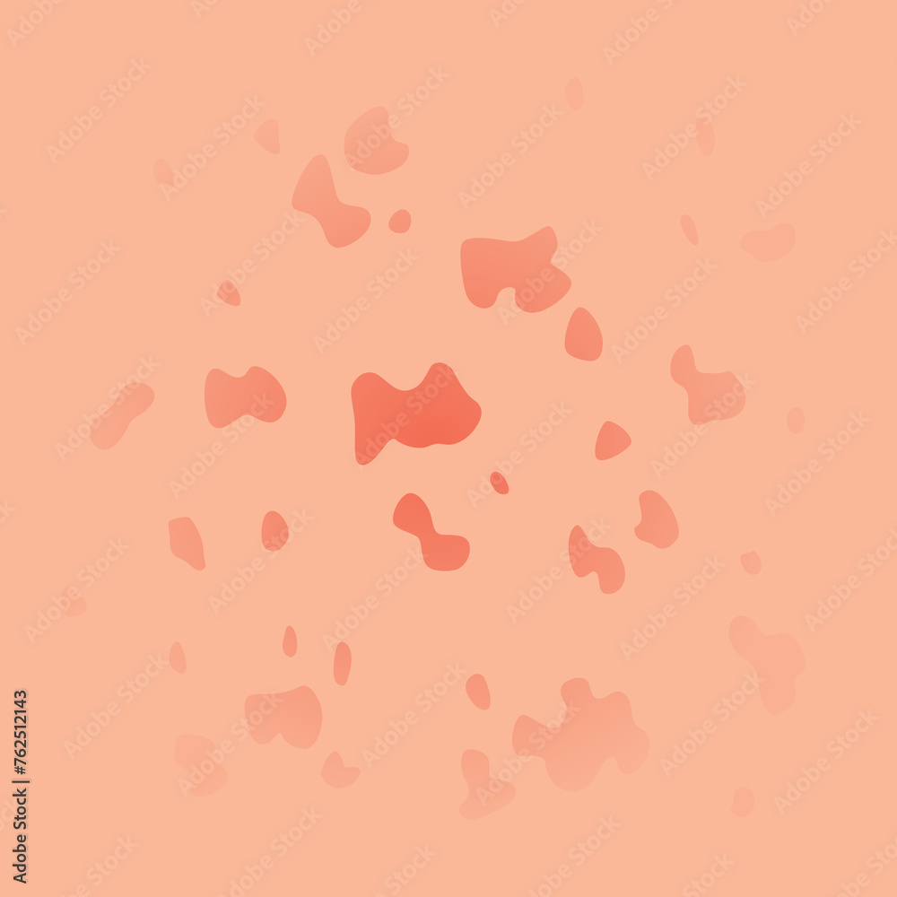 Type of psoriasis . Part of patients skin with dermatitis, inflammation ...