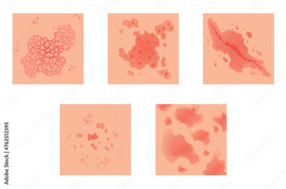 Different types of psoriasis set. Part of patients skin with dermatitis ...