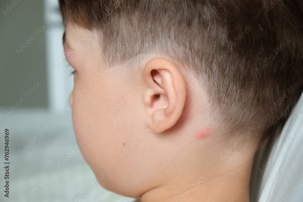 Foto de Red pimple. Concept of allergic reaction by mosquito bites. Ear ...