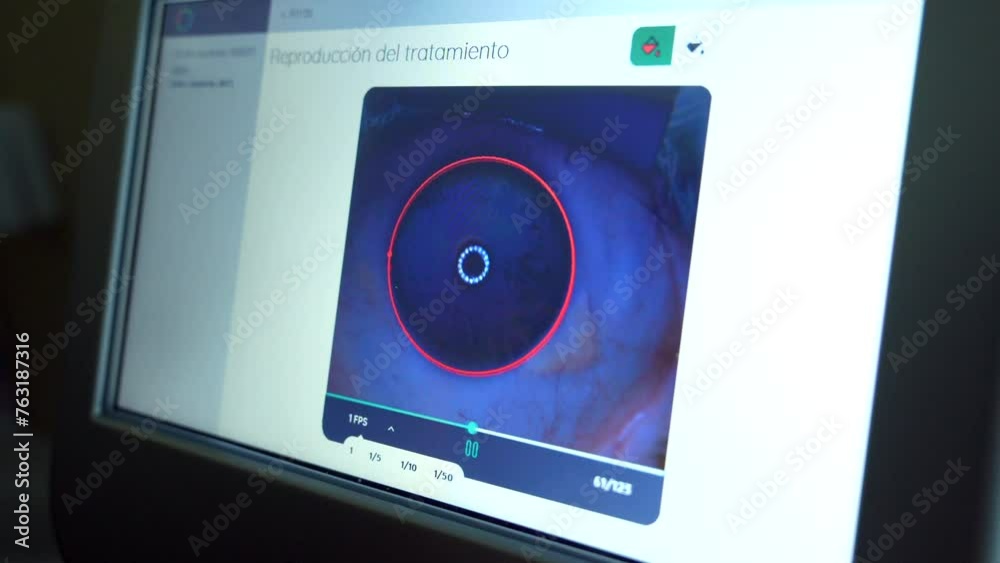 Screen used by the ophthalmologist to monitor the eye for laser ...