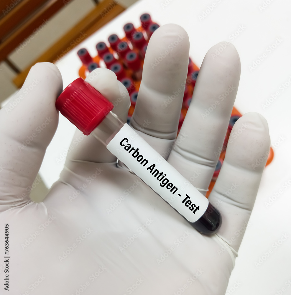 Blood sample for Carbon antigen test, VDRL or RPR test, Syphilis ...