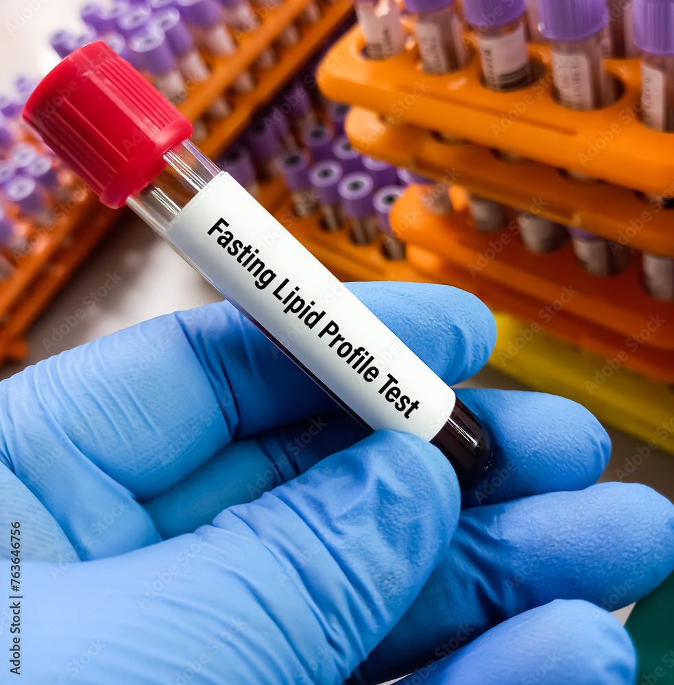 Blood sample for Fasting Lipid Profile test, (total cholesterol, tg ...