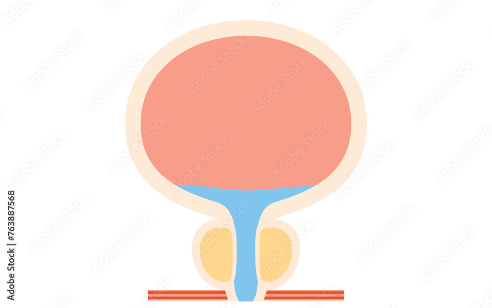 Medical illustration of benign prostatic hyperplasia, normal prostate ...