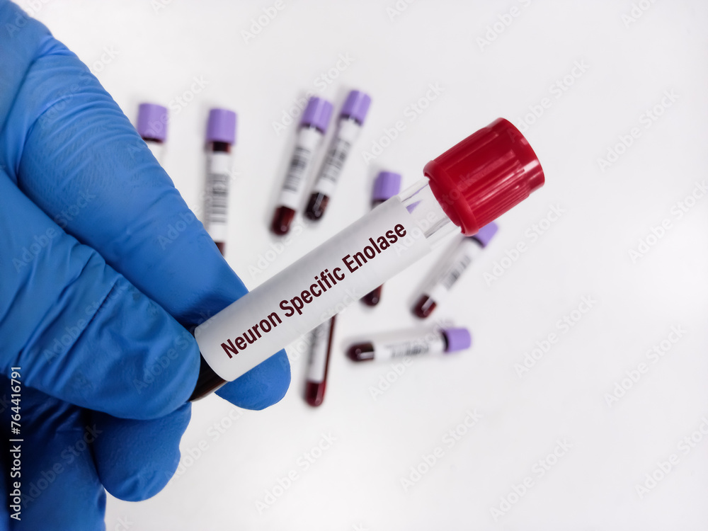Blood sample for Neuron-specific Enolase (NSE) test, marker for small ...