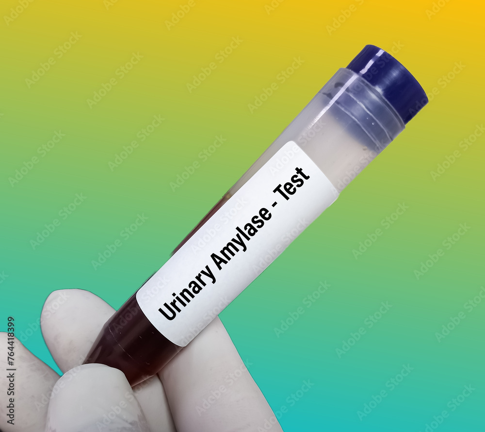 Hand hold urine sample for urine amylase test. Urinalysis. Stock Photo ...