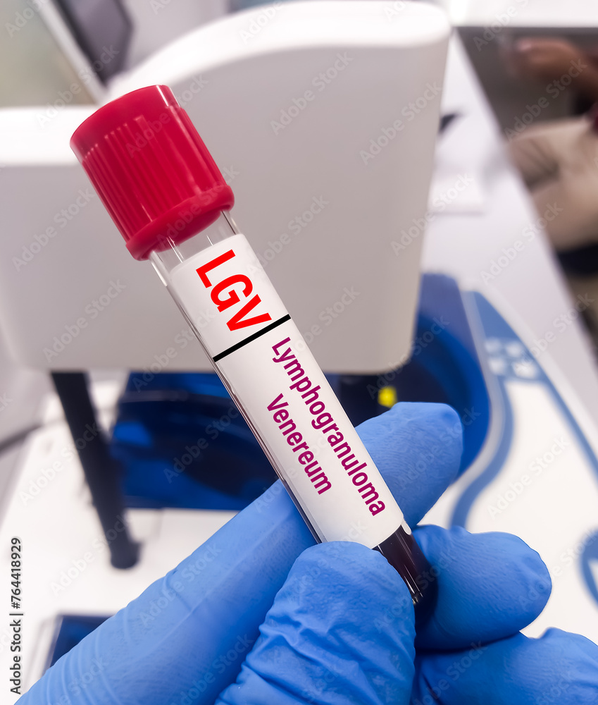 Blood sample for Lymphogranuloma Venereum (LGV) disease diagnosis test ...