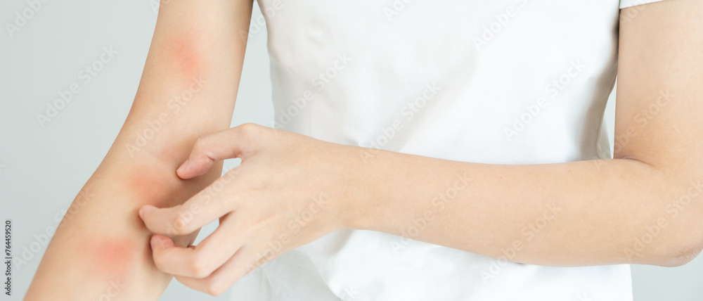 skin problem and beauty. Young woman scratch body has itchy skin from ...