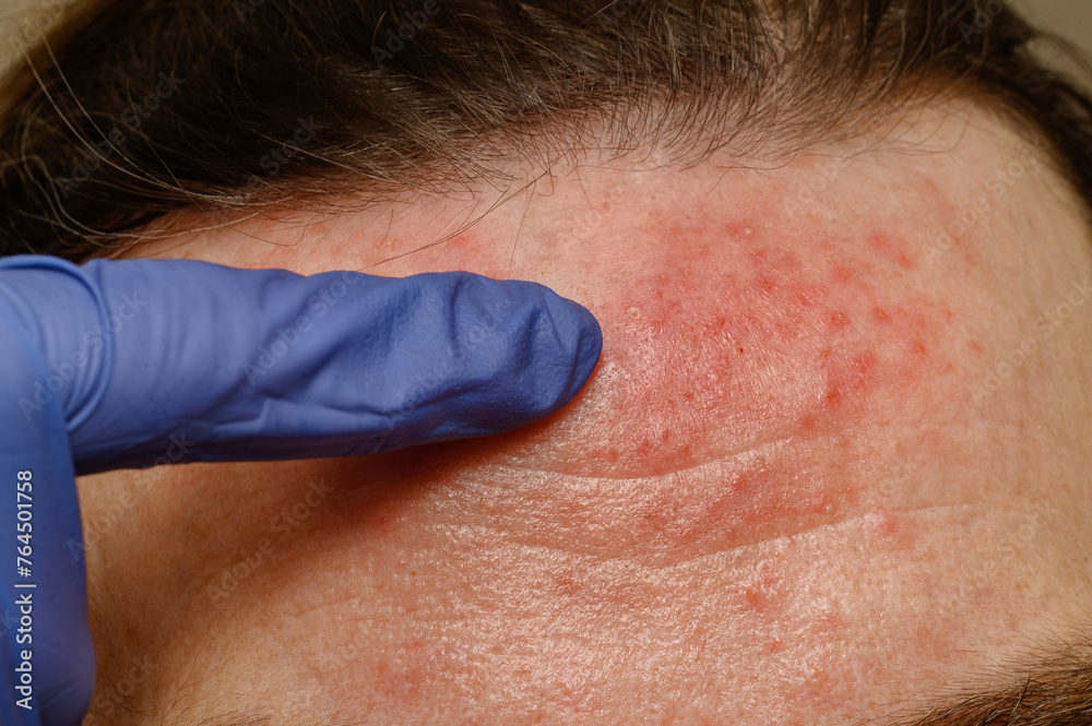 The doctor examines the skin of the forehead affected by a glandular ...
