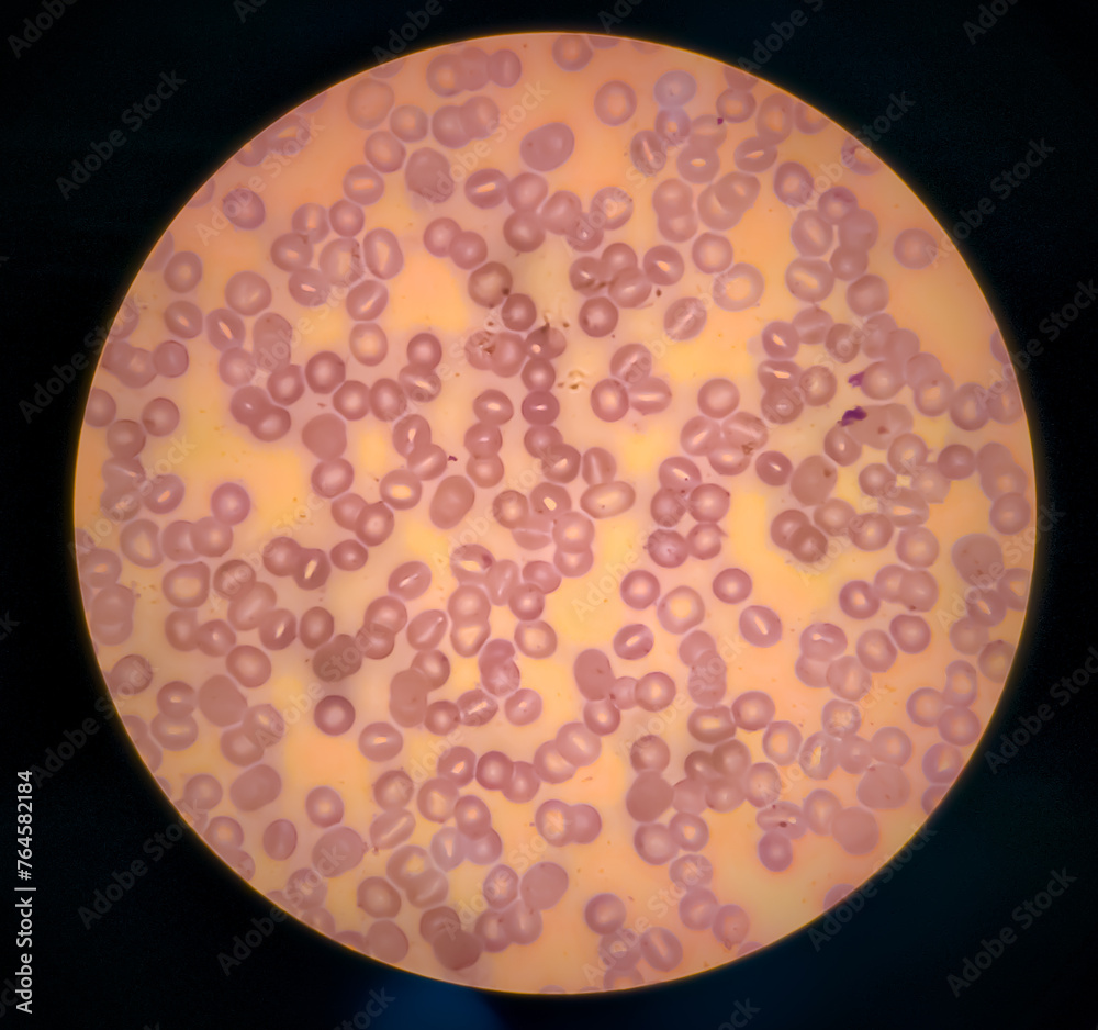 Acute thrombocytopenia and leukocytopenia with normal RBC analysed by ...