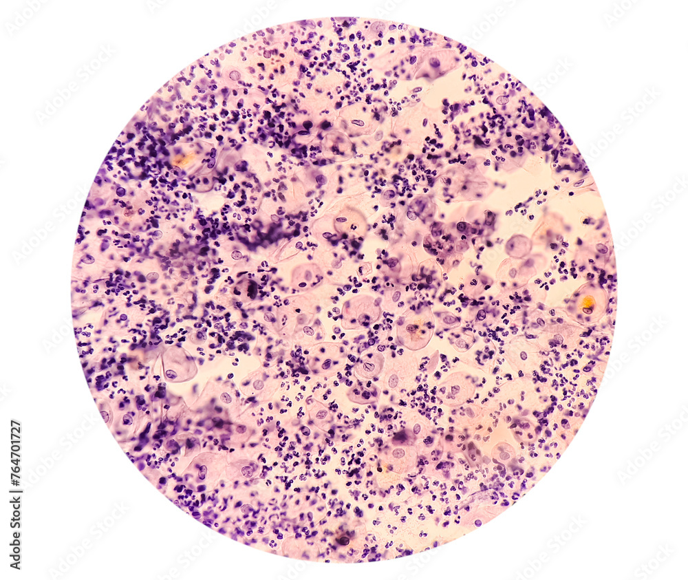 Paps smear: Inflammatory smear with HPV related changes. Cervical ...