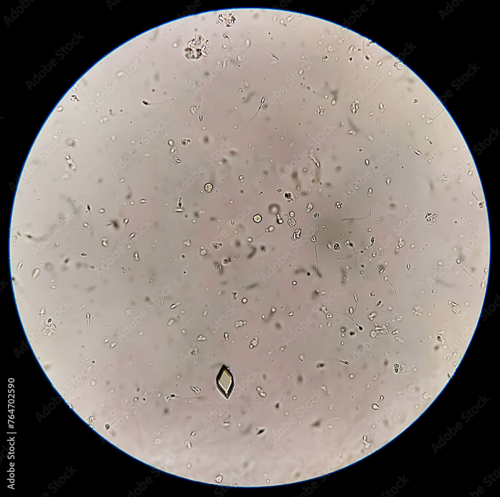 Asthenozoospermia, a common cause of human male infertility ...