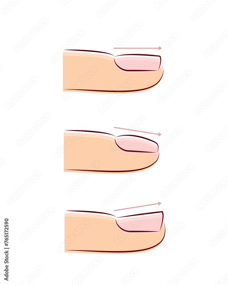 direction of nail growth, different types of fingernail, flat, convex ...