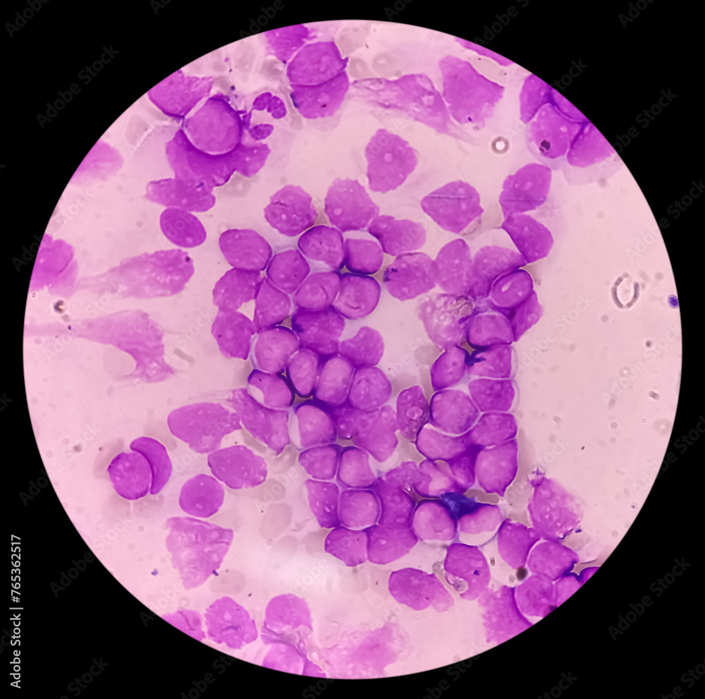 Acute leukemia, ALL(Acute lymphoblastic leukemia), peripheral blood ...