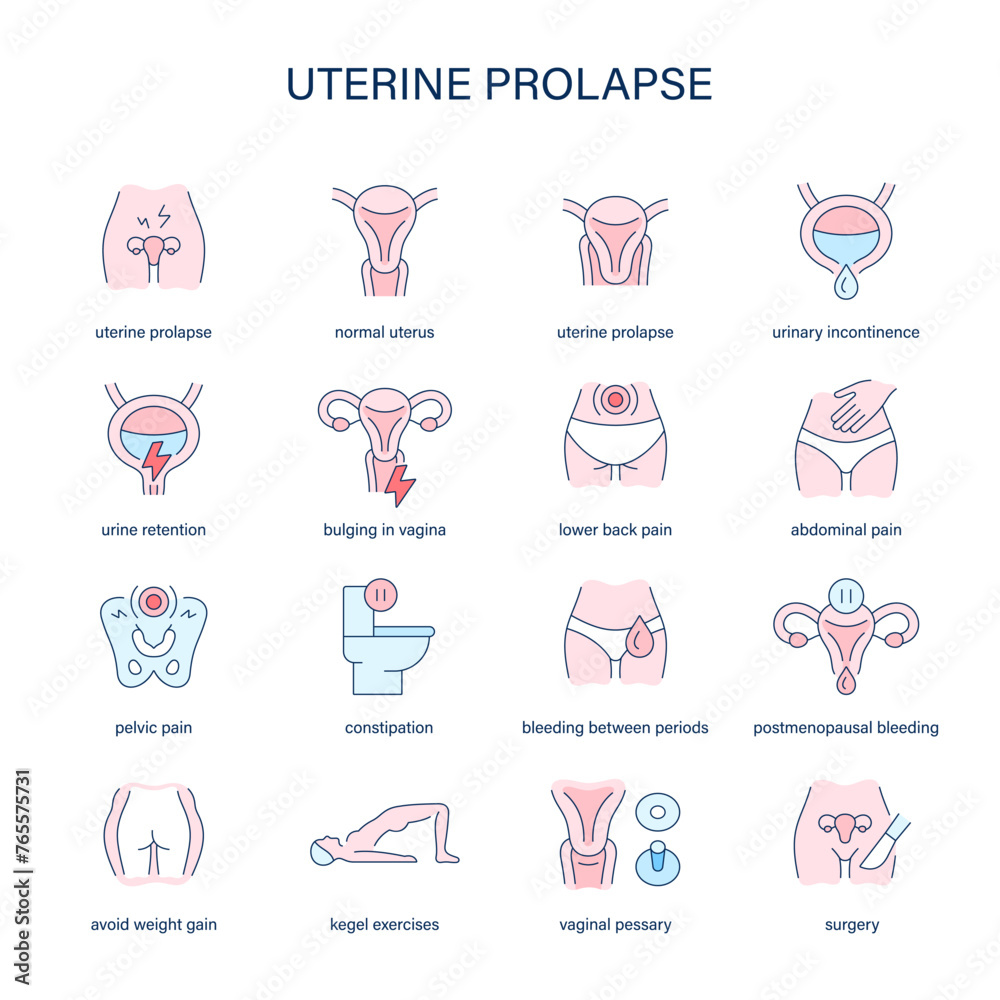 Poster Uterine Prolapse symptoms, diagnostic and treatment vector icons ...