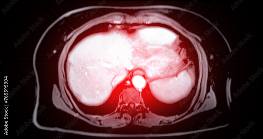 MRI of the upper abdomen is a non-invasive imaging technique providing ...