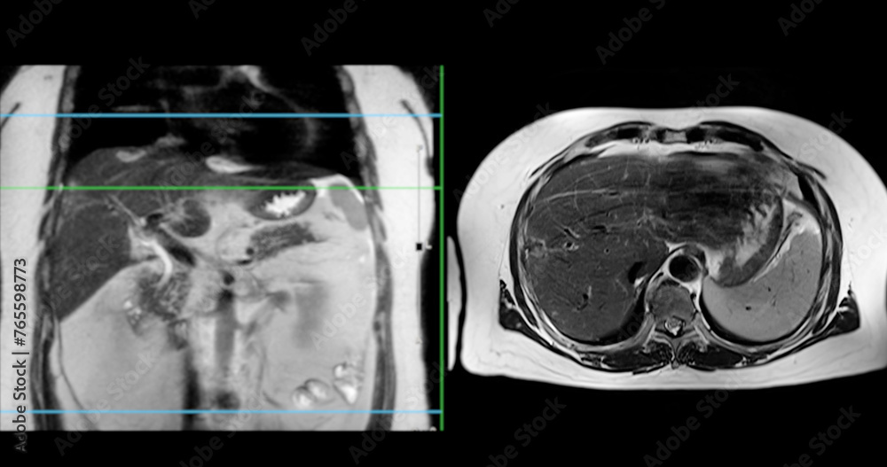 MRI of the upper abdomen is a non-invasive imaging technique providing ...