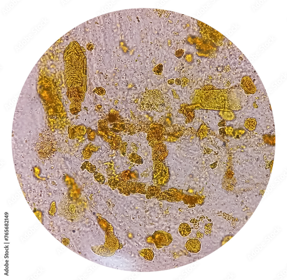 Microscopic image of urine granular cast and cellular cast, cause of ...
