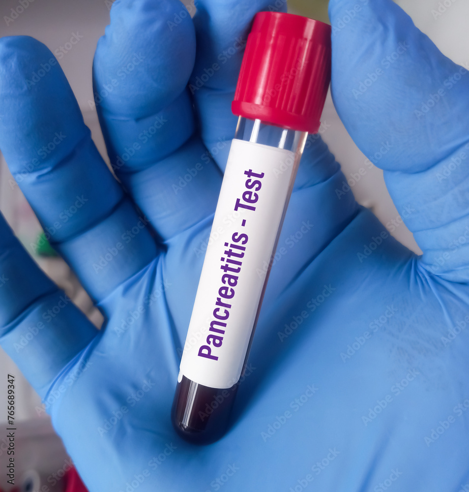 Blood sample for pancreatitis test. serum amylase test, lipase test ...