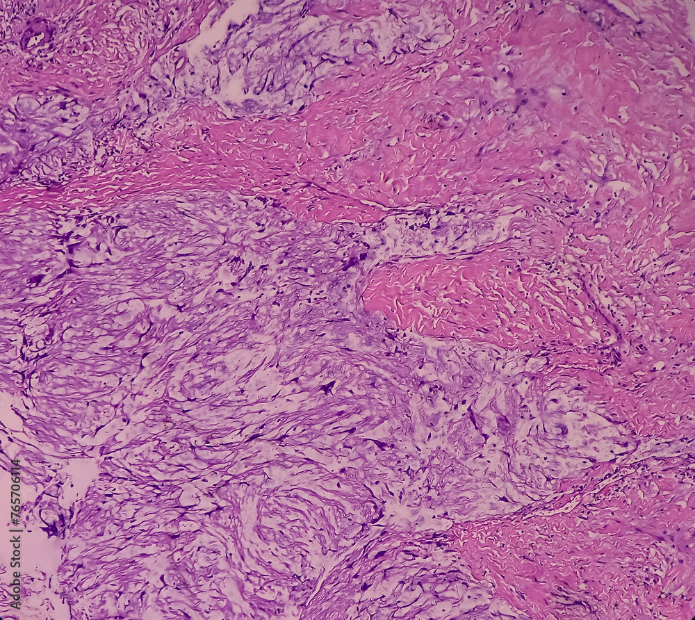 Salivary Mucoid Cyst Microscopic Show Parotid Tissue Features Of Cyst Wall Composed Of Myxoid